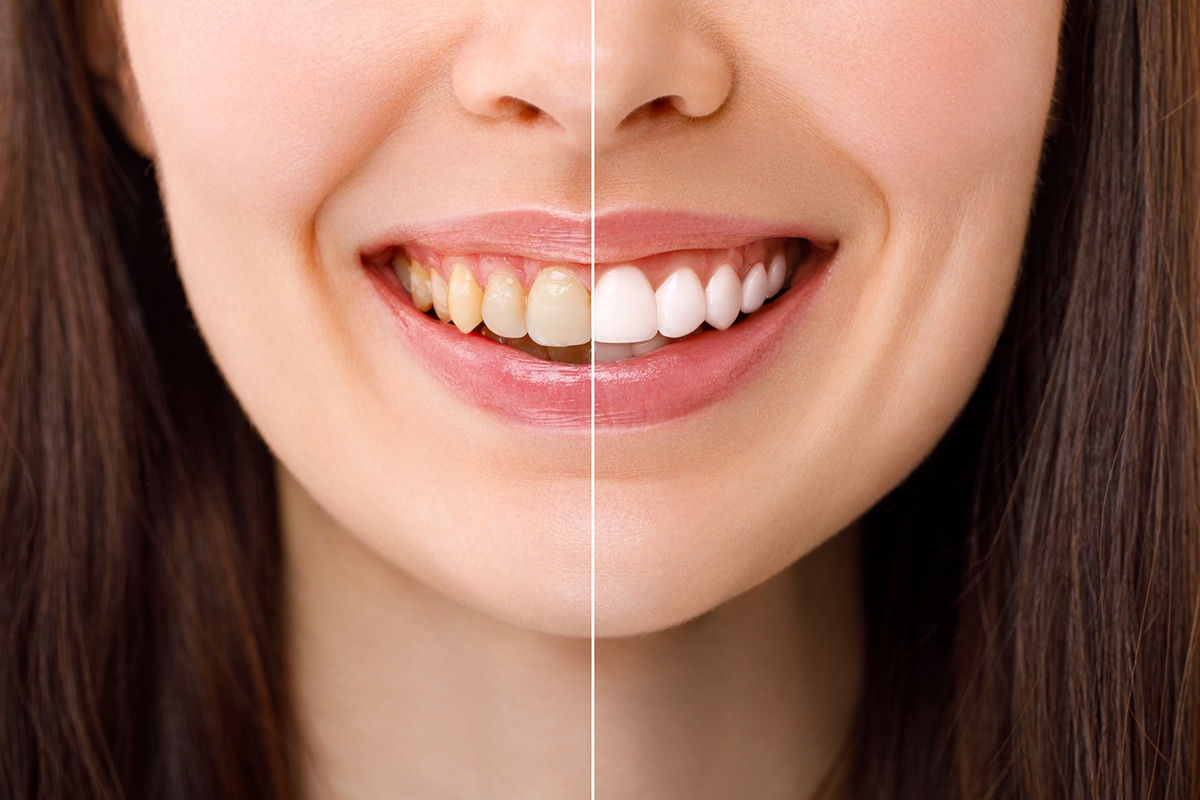 Foods That Whiten Teeth & Foods That Stain Them - Paramount Dental Arts